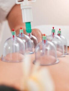Hijama Cupping Therapy excellence in Dubai